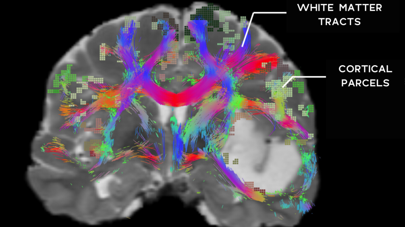 Understanding White Matter Tractography – Society for Brain Mapping and ...