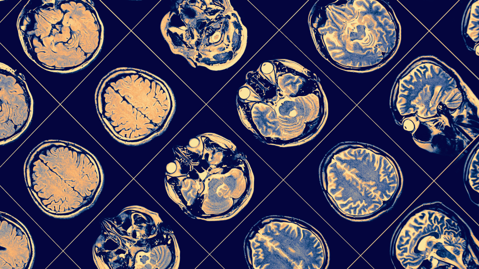 Machine Learning And Ai In Neuroimaging Analysis Society For Brain